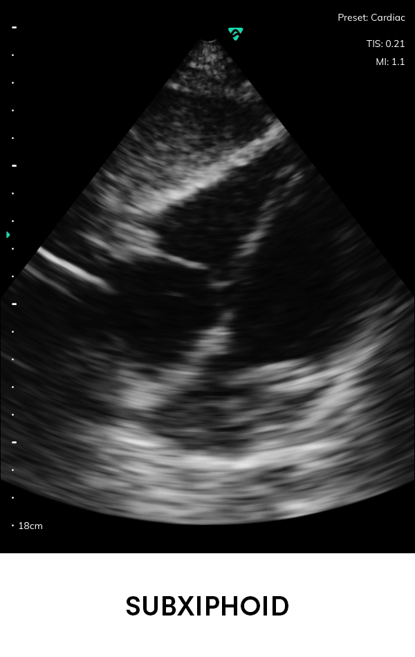 8 Best Portable Echo Ultrasound Machines for Cardiac Care