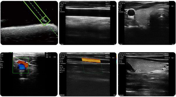 Guide des échographes portables 2025-2026 : types, utilisations et coûts